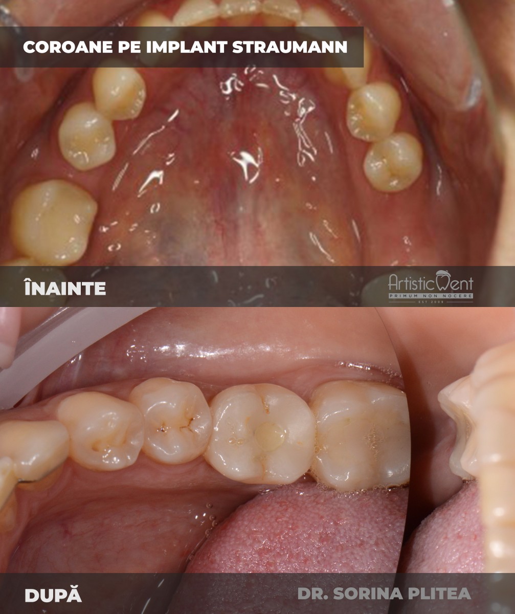 Implantul dentar straumann pure ceramic prezentare de caz